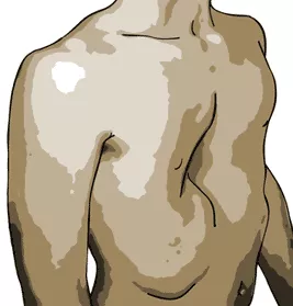 Pectus Excavatum | UCSF Surgical Oncology