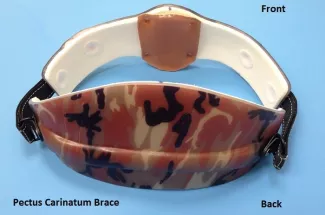 Pectus Carinatum | UCSF Surgical Oncology