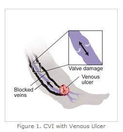 Chronic Venous Insufficiency | UCSF Surgical Oncology